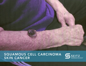 Treating squamous cell skin cancer at Seitz Dermatology - Seitz Dermatology